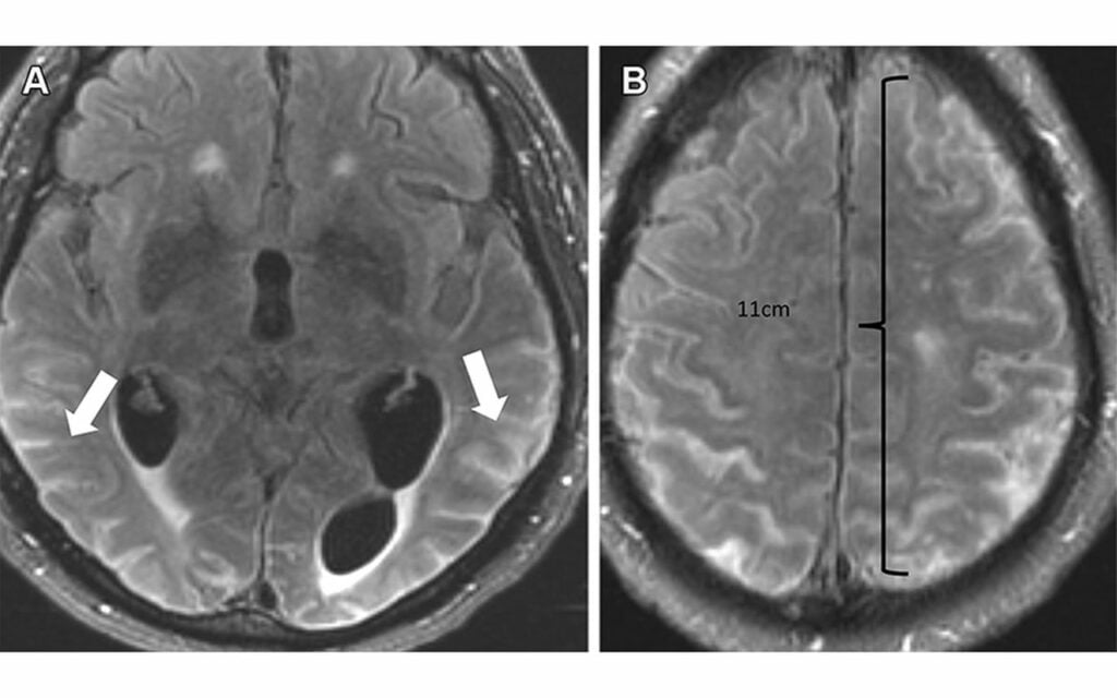 ARIA in Lacanemab, Donanemab and Aduhelm